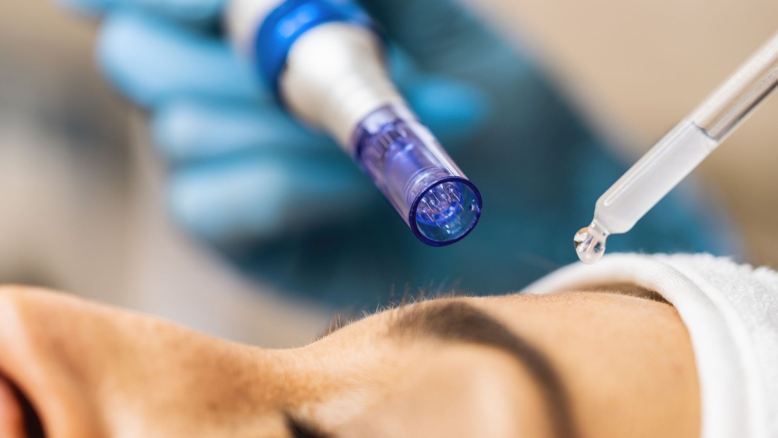PRP + Microneedling | Vampire Facial Treatment Oakville, Ontario